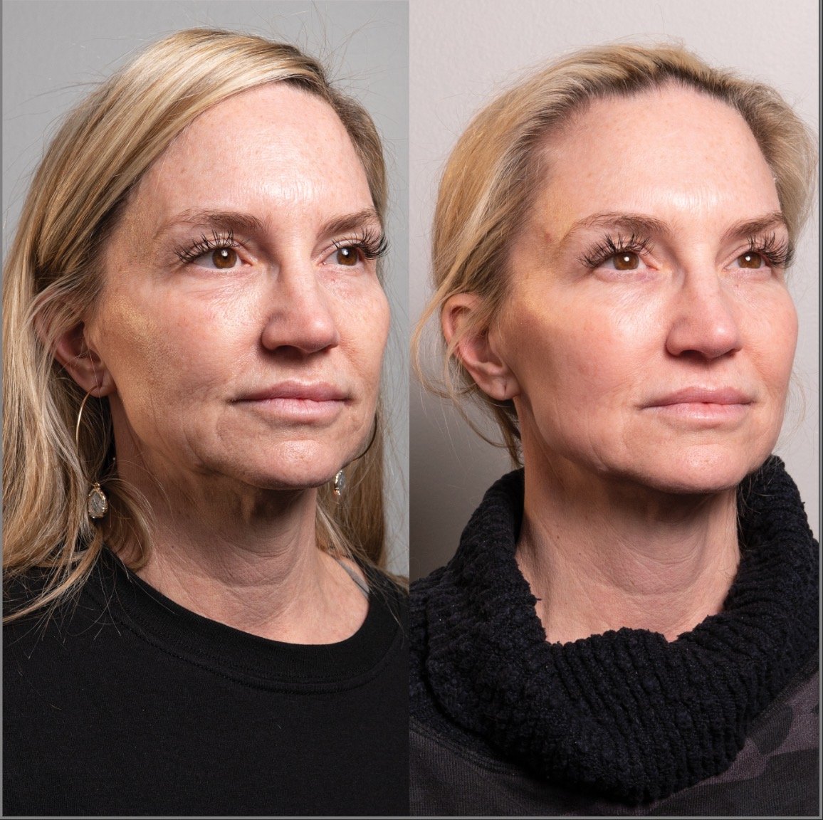 Sylfirm-X RF Microneedling In Denver, CO - skindenver.co