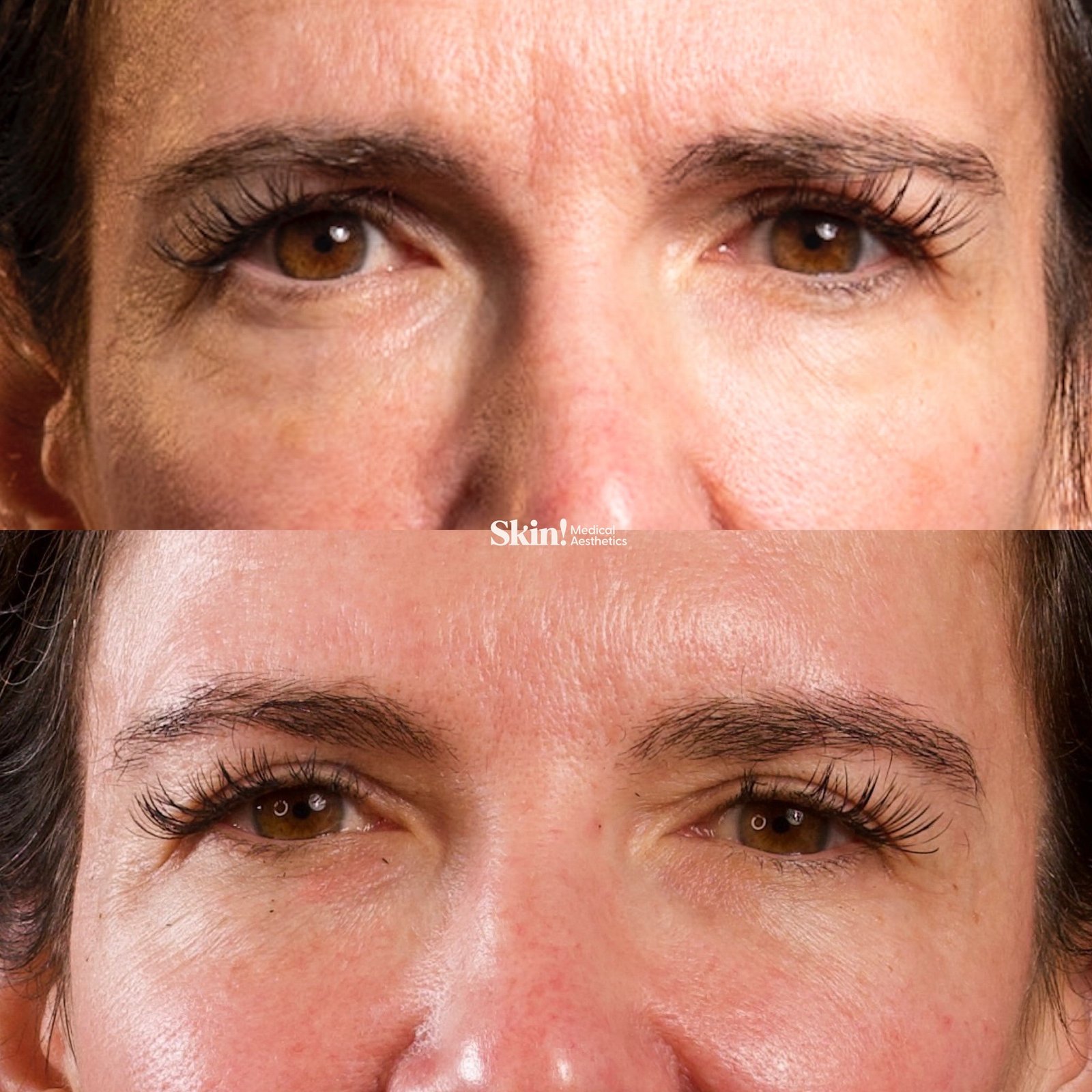 Sylfirm-X RF Microneedling In Denver, CO - skindenver.co